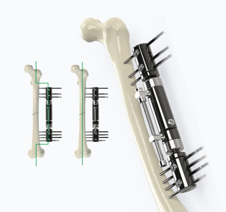 Fixador externo para tíbia - 5014 series - Zimed Medical - para fêmur ...