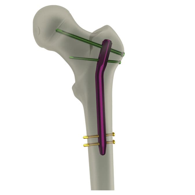 Haste intramedular para fêmur - PediFIN® - WishBone Medical - fixação ...