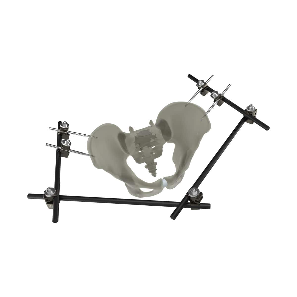 Fixador externo de pelve - UniX® - WishBone Medical - tubular