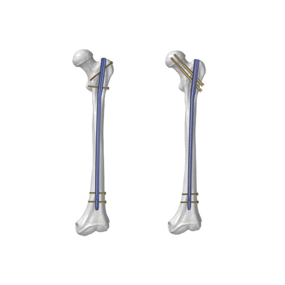 Haste intramedular para fêmur - KTO - Kangli Medical - fixação proximal ...