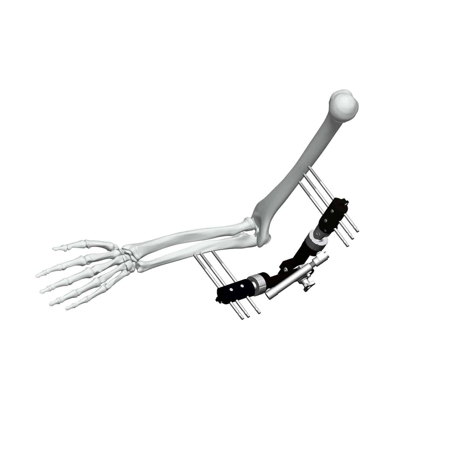 Fixador externo para cotovelo - FE5M-D040 - Chongqing FWS Medical ...
