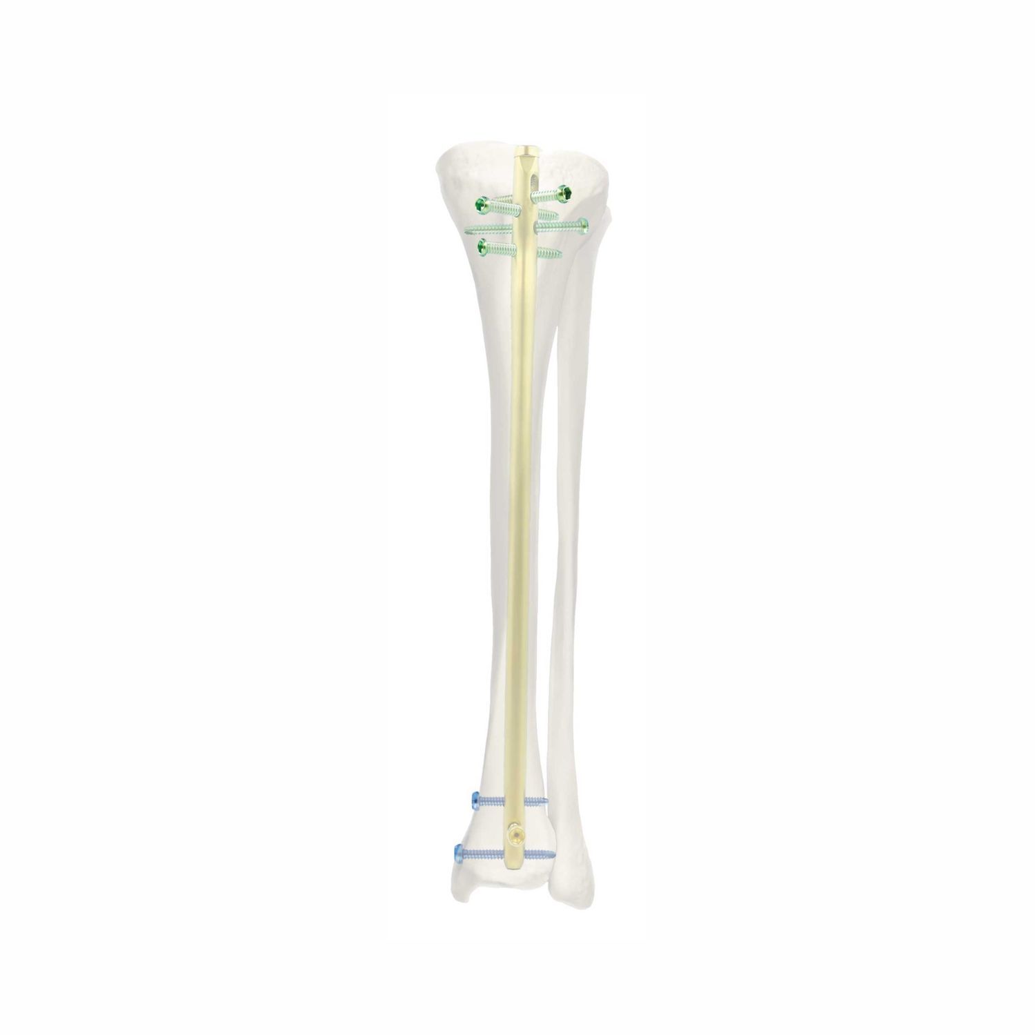 Haste intramedular para tíbia - SJGK - Chongqing FWS Medical Device