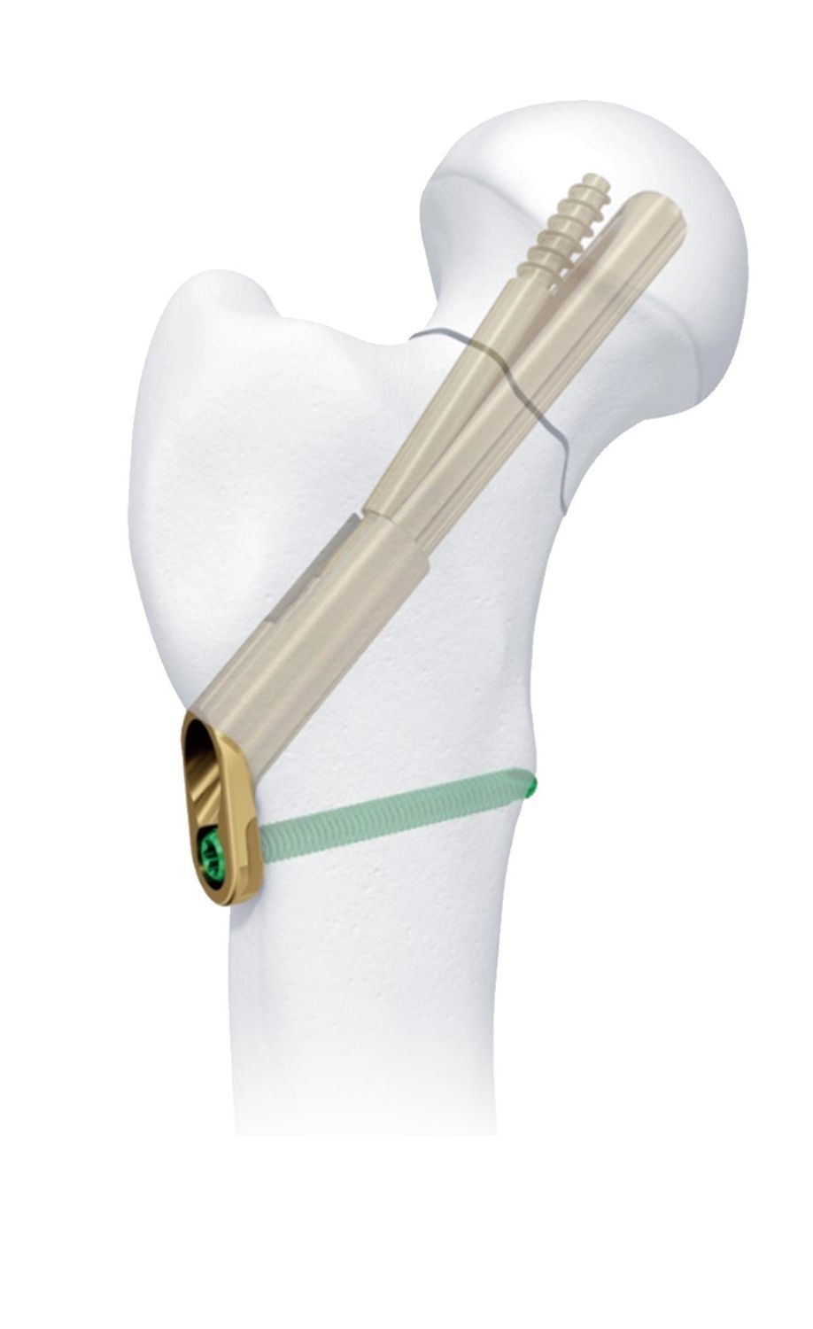 Haste intramedular para fêmur - GJD-P - Chongqing FWS Medical Device ...