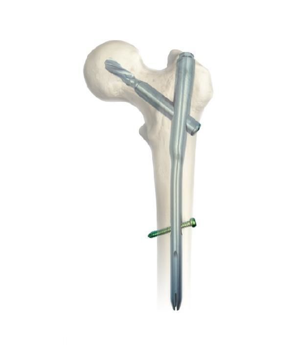 Haste intramedular para fêmur - SGM - Chongqing FWS Medical Device ...