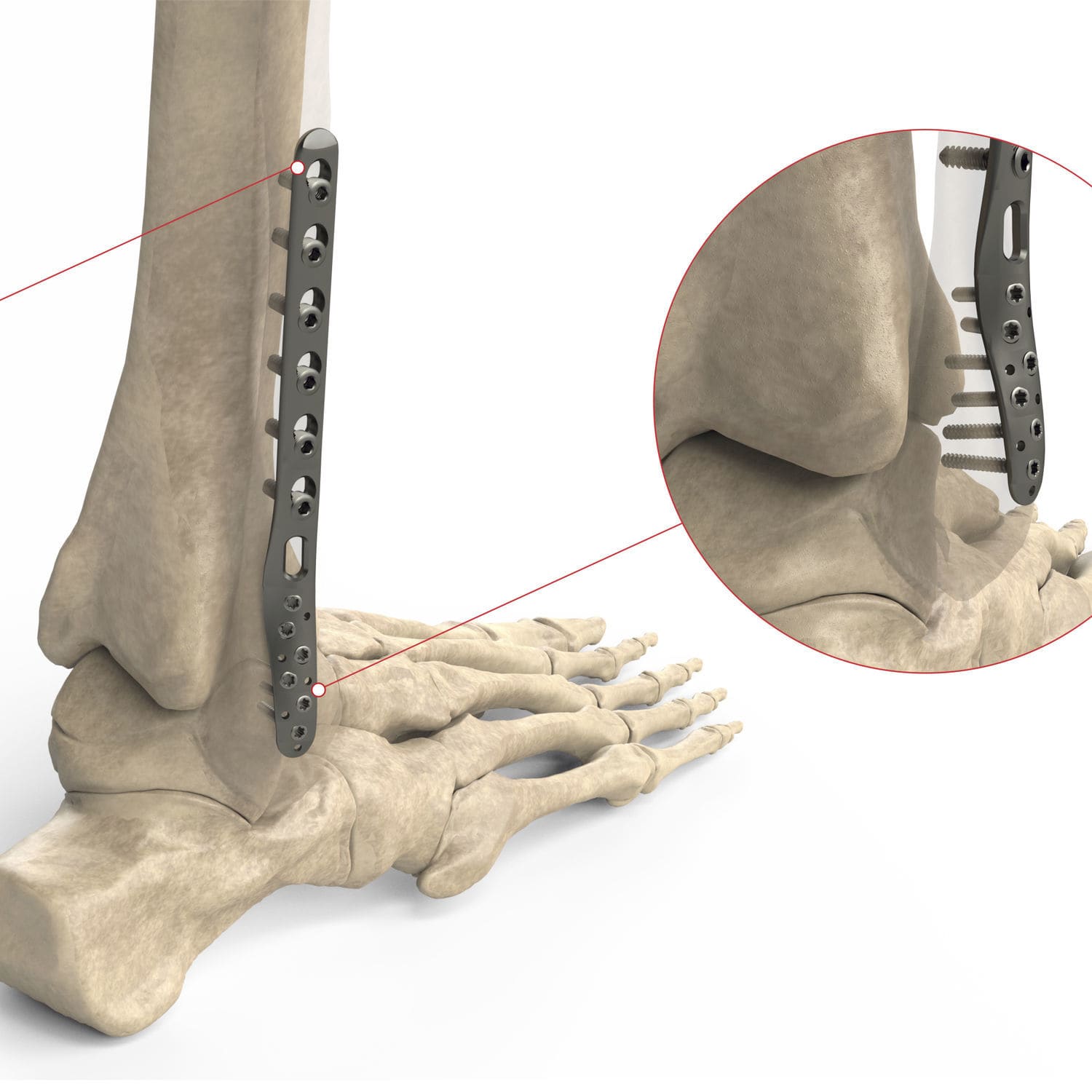 Placa de compressão óssea para fíbula - Ases Orthopedics - distal ...
