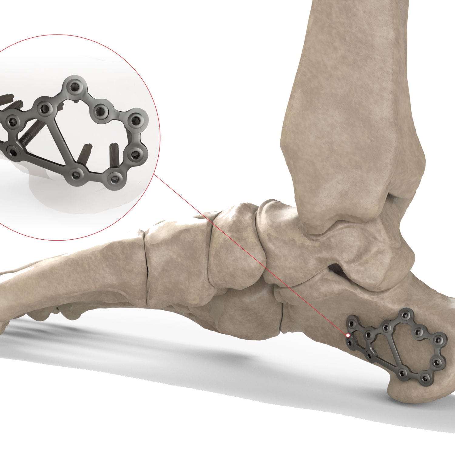 Placa de compressão óssea para calcâneo - Ases Orthopedics - bloqueada