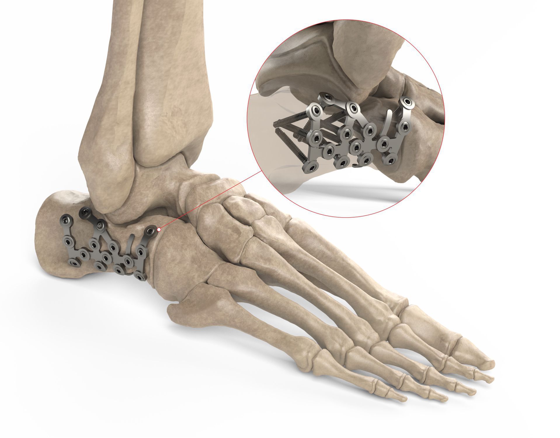 Placa de compressão óssea para calcâneo - Ases Orthopedics