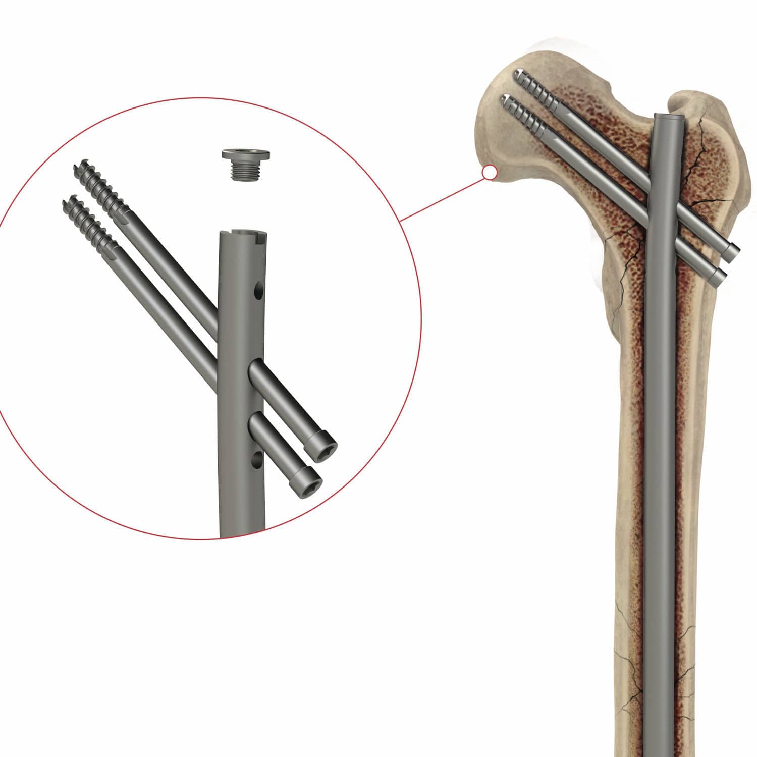 Haste intramedular para fêmur - 4T1-4001050 - Ases Orthopedics ...