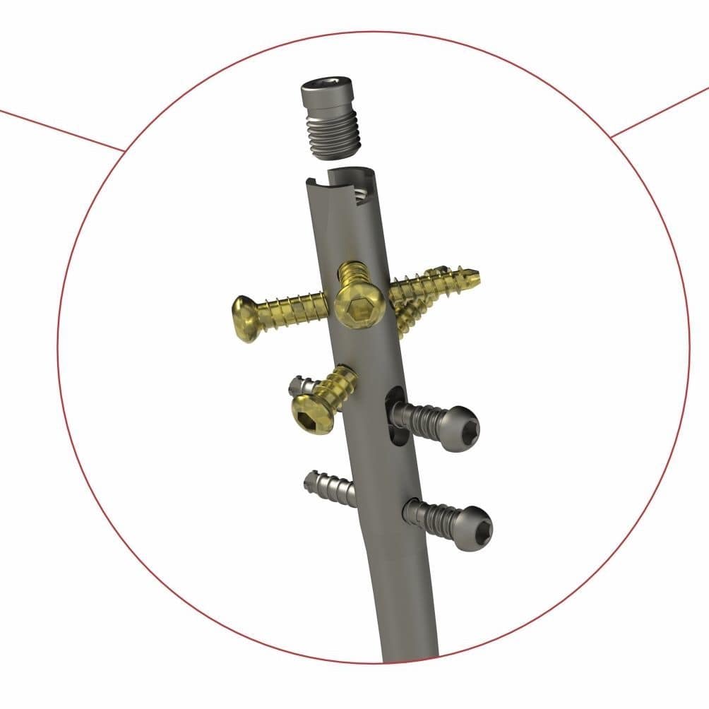 Haste intramedular para tíbia - 4T1-4011000 - Ases Orthopedics