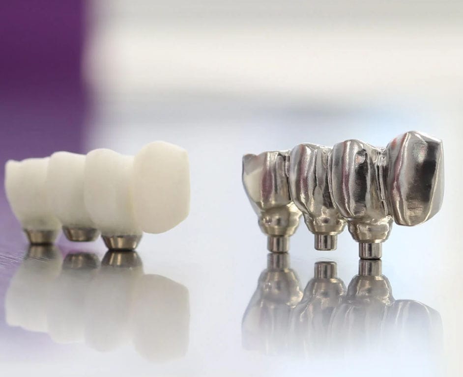 Ponte dentária em titânio - Copywax - Panthera Dental - em cromo ...