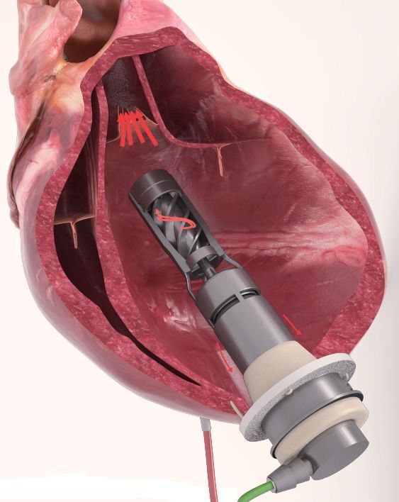 Dispositivo de assistência ventricular para adulto - FLOWMAKER ® - FineHeart
