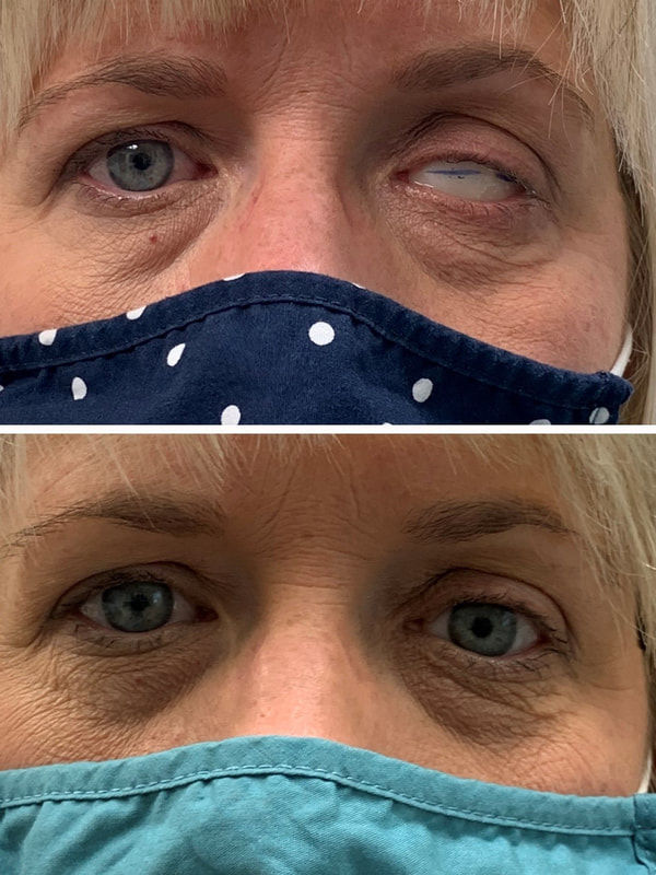 Prótese estética ocular - The Anaplastology Clinic - para adulto