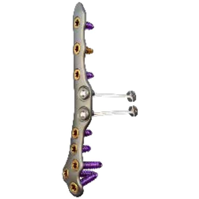 Placa de compressão óssea para tíbia - ORTHOLOC™ 2 - Wright Medical ...