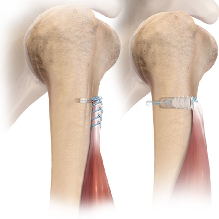 Âncora de sutura tendão bicipital - FiberTak® 2-0 FiberLink™ - Arthrex ...