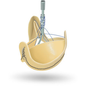Prótese cardiovascular de aorta ascendente - CARBO-SEAL VALSALVA ...