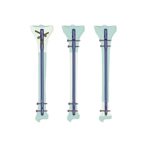 Haste intramedular para tíbia - KTO - Kangli Medical - fixação proximal ...