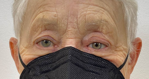 Prótese estética ocular - Scleral Shells - The Anaplastology Clinic ...