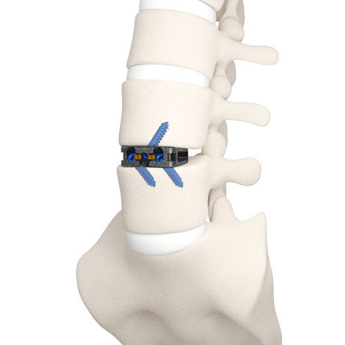 Espaçador intervertebral lombar - DYNA-LINK® - Life Spine - via ...
