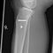 Haste intramedular para tíbia - CarboFix Orthopedics - distal ...